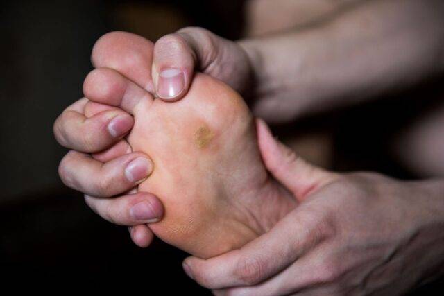 Liktorn: Komplett guide om årsaker og behandling av liktorn